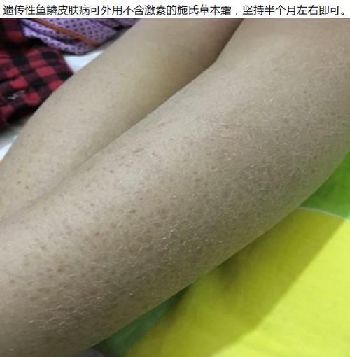 鱼鳞病会遗传吗_鱼鳞病怎么治最好-第1张图片-山城妙识 鱼鳞病会遗传吗_鱼鳞病怎么治最好-第1张图片-山城妙识