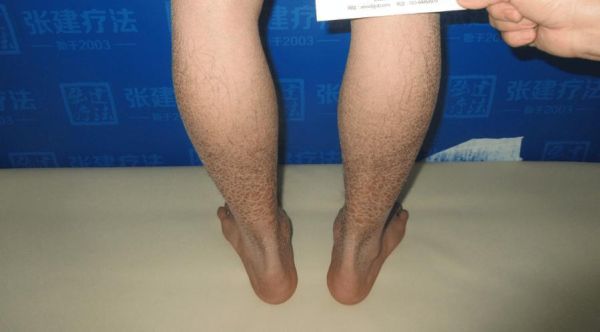 鱼鳞病会遗传吗_鱼鳞病怎么治最好-第3张图片-山城妙识 鱼鳞病会遗传吗_鱼鳞病怎么治最好-第3张图片-山城妙识