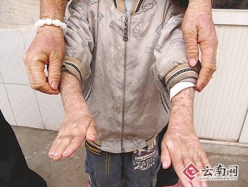 鱼鳞病会遗传吗_鱼鳞病怎么治最好-第2张图片-山城妙识 鱼鳞病会遗传吗_鱼鳞病怎么治最好-第2张图片-山城妙识