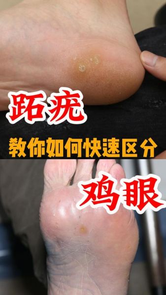 鸡眼是怎么形成的_鸡眼和跖疣的区别-第1张图片-山城妙识