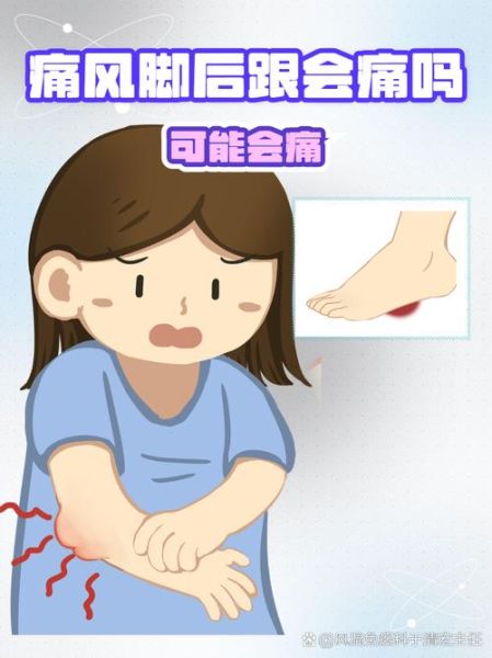 脚疼是不是痛风_痛风脚疼怎么判断-第3张图片-山城妙识