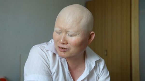 脆骨病的症状是什么_脆骨病有哪些表现-第3张图片-山城妙识