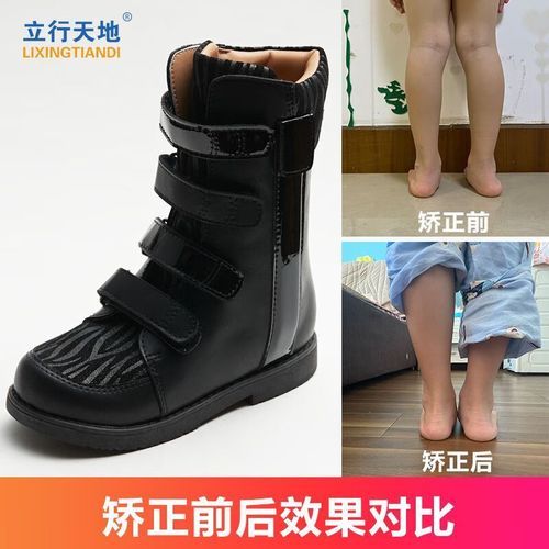马蹄足内翻矫正鞋怎么选_马蹄足内翻矫正鞋多少钱-第1张图片-山城妙识