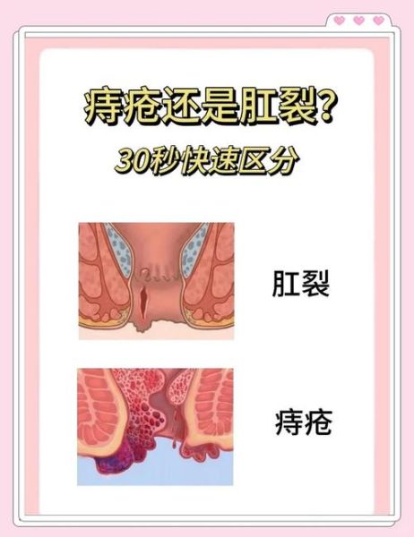 肛裂和痔疮的区别_怎么判断自己是肛裂还是痔疮-第1张图片-山城妙识