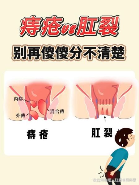 肛裂和痔疮的区别_怎么判断自己是肛裂还是痔疮-第2张图片-山城妙识