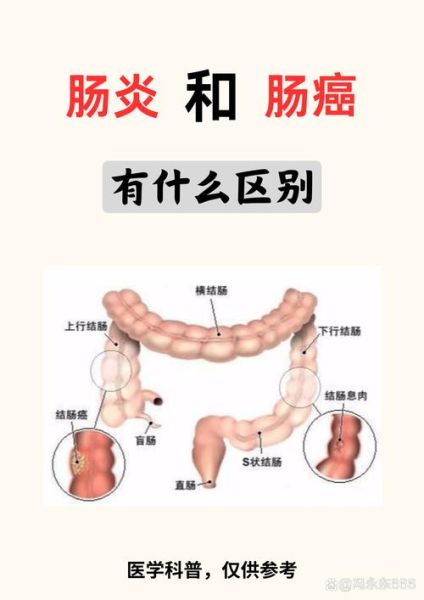 肠炎和肠癌的症状区别_怎么区分-第3张图片-山城妙识 肠炎和肠癌的症状区别_怎么区分-第3张图片-山城妙识