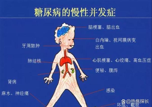 糖尿病10年突然好了_真的可能吗-第2张图片-山城妙识 糖尿病10年突然好了_真的可能吗-第2张图片-山城妙识