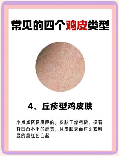 鸡皮肤怎么消除偏方_鸡皮肤用什么最有效-第1张图片-山城妙识 鸡皮肤怎么消除偏方_鸡皮肤用什么最有效-第1张图片-山城妙识