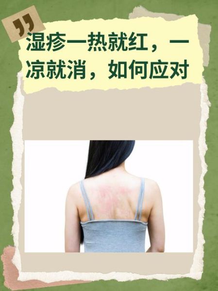 血热的症状有哪些_湿疹反复发作怎么办-第3张图片-山城妙识