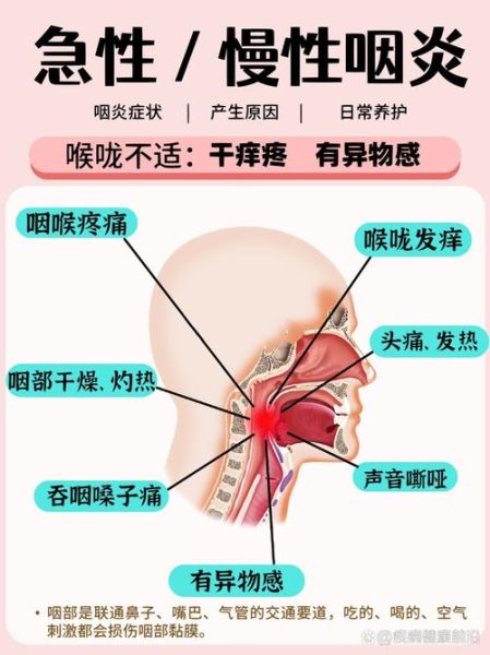 嗓子太疼了咽唾液都疼怎么办_快速缓解方法-第3张图片-山城妙识 嗓子太疼了咽唾液都疼怎么办_快速缓解方法-第3张图片-山城妙识