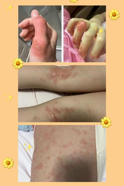 精油中毒八年后的症状_如何康复-第1张图片-山城妙识 精油中毒八年后的症状_如何康复-第1张图片-山城妙识