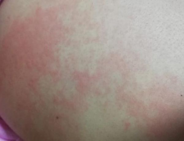 精油中毒八年后的症状_如何康复-第2张图片-山城妙识 精油中毒八年后的症状_如何康复-第2张图片-山城妙识