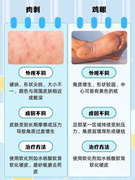 肉刺和鸡眼的区别图片_怎么分辨-第2张图片-山城妙识 肉刺和鸡眼的区别图片_怎么分辨-第2张图片-山城妙识