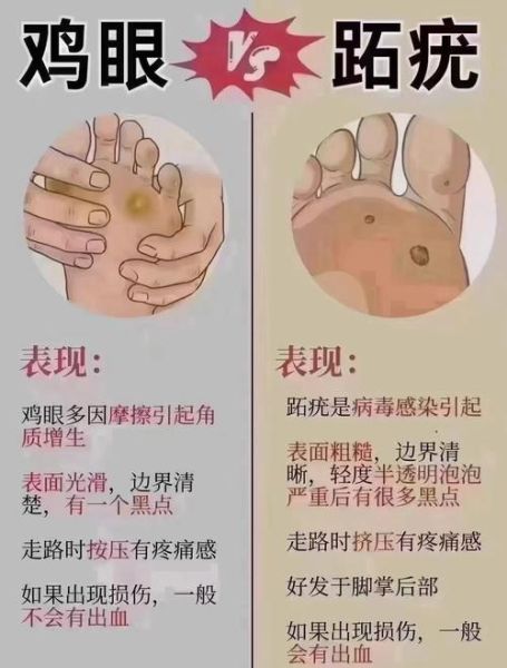 肉刺和鸡眼的区别图片_怎么分辨-第3张图片-山城妙识 肉刺和鸡眼的区别图片_怎么分辨-第3张图片-山城妙识