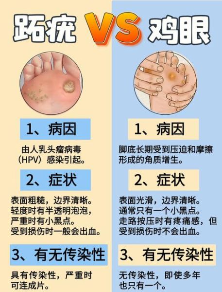 肉刺和鸡眼的区别图片_怎么分辨-第1张图片-山城妙识 肉刺和鸡眼的区别图片_怎么分辨-第1张图片-山城妙识