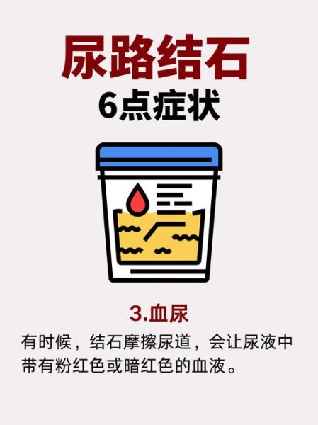 肾结石有什么症状_肾结石疼痛怎么办-第3张图片-山城妙识 肾结石有什么症状_肾结石疼痛怎么办-第3张图片-山城妙识