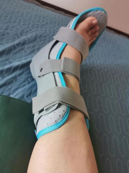 骨折打石膏的作用是什么_石膏固定多久能拆-第3张图片-山城妙识 骨折打石膏的作用是什么_石膏固定多久能拆-第3张图片-山城妙识