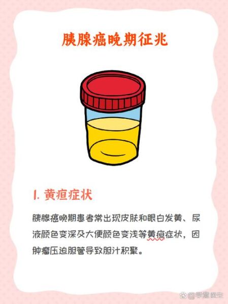 胰脏癌早期症状有哪些_胰脏癌能活多久-第3张图片-山城妙识 胰脏癌早期症状有哪些_胰脏癌能活多久-第3张图片-山城妙识