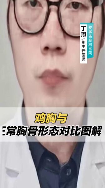 鸡胸严重和轻度图片区别_如何判断鸡胸程度-第1张图片-山城妙识