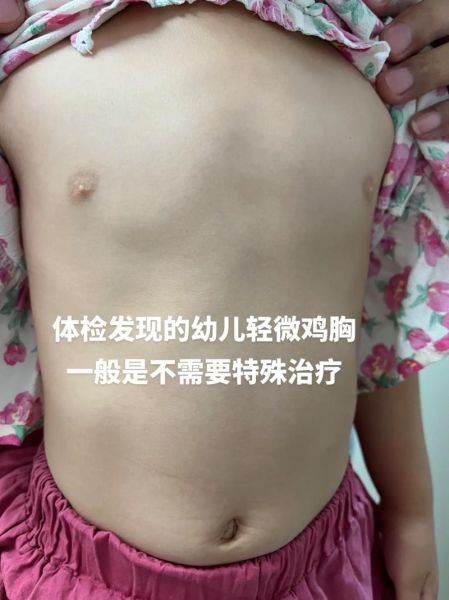 鸡胸严重和轻度图片区别_如何判断鸡胸程度-第2张图片-山城妙识