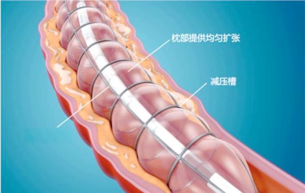 巧克力球囊是什么_巧克力球囊多少钱-第2张图片-山城妙识 巧克力球囊是什么_巧克力球囊多少钱-第2张图片-山城妙识