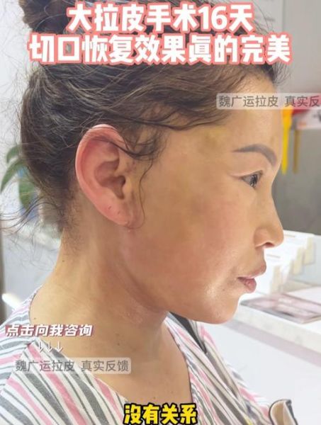 大拉皮手术15天照片_恢复期多久-第1张图片-山城妙识