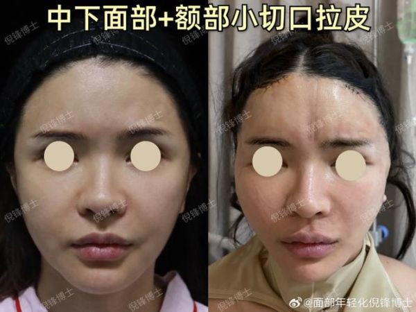 大拉皮手术15天照片_恢复期多久-第3张图片-山城妙识