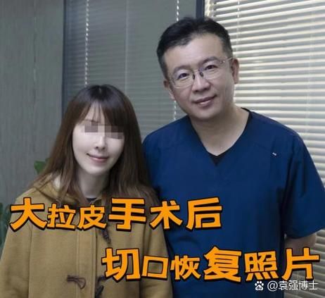 大拉皮手术15天照片_恢复期多久-第2张图片-山城妙识