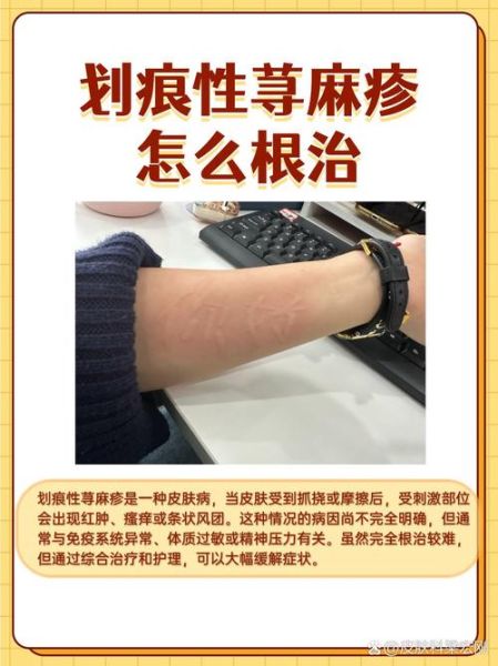 荨麻疹怎么快速自愈_荨麻疹自愈方法有哪些-第2张图片-山城妙识