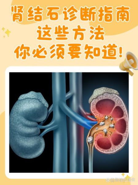 肾结石是怎么引起的_肾结石形成原因有哪些-第3张图片-山城妙识 肾结石是怎么引起的_肾结石形成原因有哪些-第3张图片-山城妙识