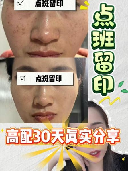 色素沉着能自然恢复吗_多久见效-第3张图片-山城妙识 色素沉着能自然恢复吗_多久见效-第3张图片-山城妙识