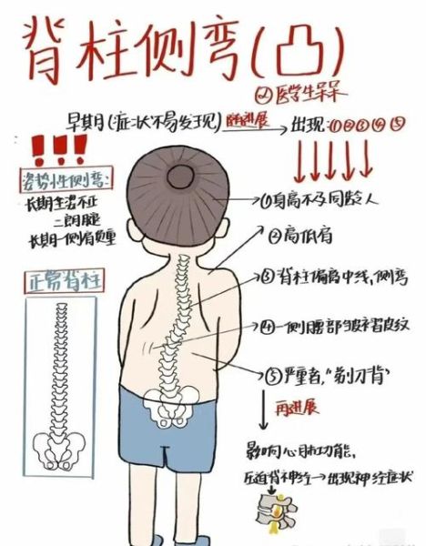 脊骨弯曲能矫正吗_脊骨弯曲矫正方法有哪些-第2张图片-山城妙识 脊骨弯曲能矫正吗_脊骨弯曲矫正方法有哪些-第2张图片-山城妙识