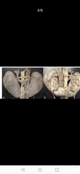 马蹄肾是什么_马蹄肾有什么症状-第2张图片-山城妙识 马蹄肾是什么_马蹄肾有什么症状-第2张图片-山城妙识