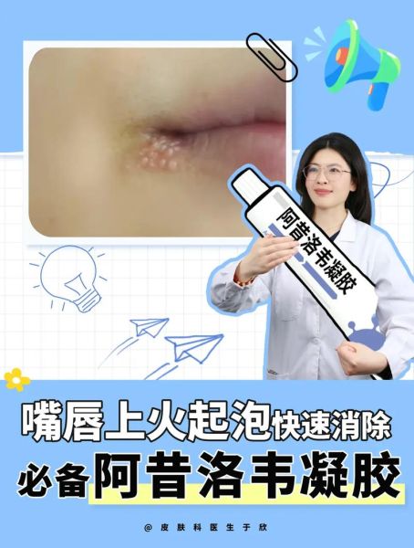 嘴皮起泡上火怎么快速消除_嘴角起泡吃什么药好得快-第1张图片-山城妙识 嘴皮起泡上火怎么快速消除_嘴角起泡吃什么药好得快-第1张图片-山城妙识