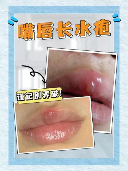 嘴皮起泡上火怎么快速消除_嘴角起泡吃什么药好得快-第2张图片-山城妙识 嘴皮起泡上火怎么快速消除_嘴角起泡吃什么药好得快-第2张图片-山城妙识