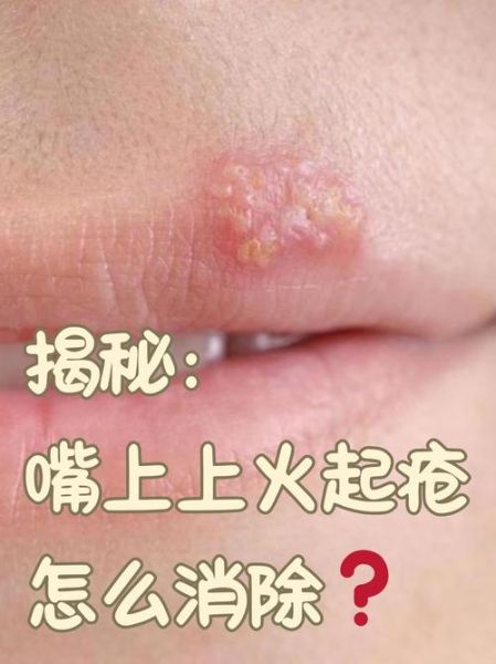 嘴皮起泡上火怎么快速消除_嘴角起泡吃什么药好得快-第3张图片-山城妙识 嘴皮起泡上火怎么快速消除_嘴角起泡吃什么药好得快-第3张图片-山城妙识