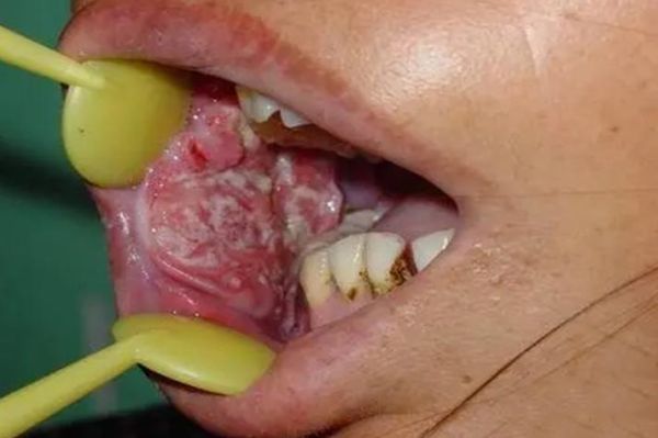吃槟榔口腔癌图片_槟榔致癌多久出现-第1张图片-山城妙识