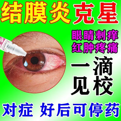过敏性结膜炎怎么根治_过敏性结膜炎用什么眼药水-第1张图片-山城妙识 过敏性结膜炎怎么根治_过敏性结膜炎用什么眼药水-第1张图片-山城妙识