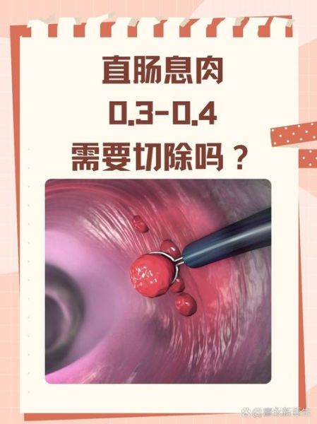 直肠息肉会癌变吗_直肠息肉切除后多久恢复-第1张图片-山城妙识 直肠息肉会癌变吗_直肠息肉切除后多久恢复-第1张图片-山城妙识