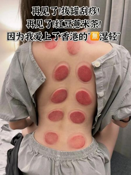 拔火罐能去湿气吗_湿气重拔火罐有效吗-第1张图片-山城妙识