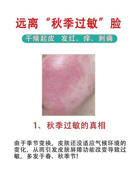 过敏症状有哪些表现_过敏症状怎么快速缓解-第2张图片-山城妙识 过敏症状有哪些表现_过敏症状怎么快速缓解-第2张图片-山城妙识