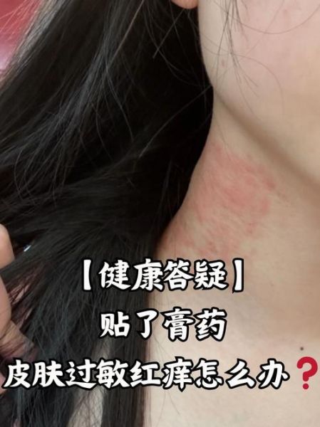 过敏症状有哪些表现_过敏症状怎么快速缓解-第3张图片-山城妙识 过敏症状有哪些表现_过敏症状怎么快速缓解-第3张图片-山城妙识