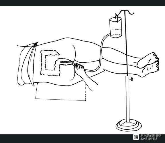 如何在家灌肠_灌肠的正确步骤-第1张图片-山城妙识