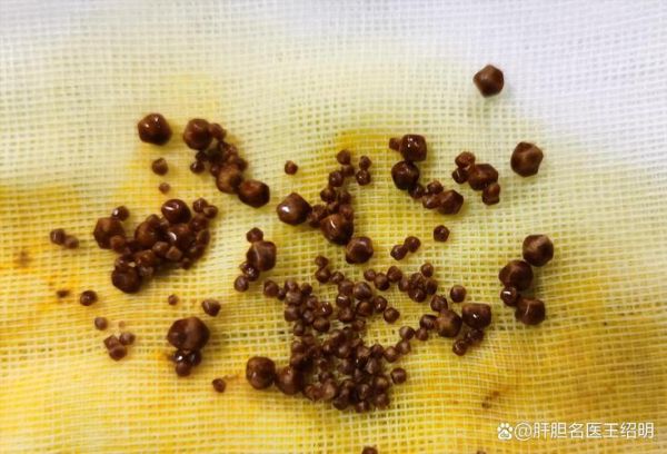 2厘米胆结石自己消失了_胆结石能自愈吗-第2张图片-山城妙识