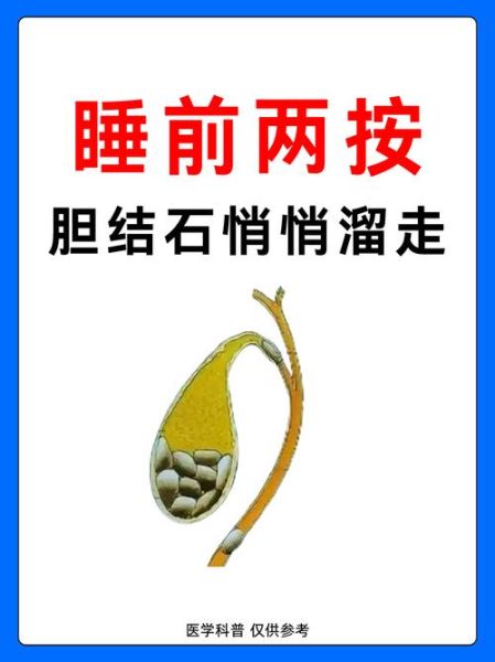 2厘米胆结石自己消失了_胆结石能自愈吗-第3张图片-山城妙识