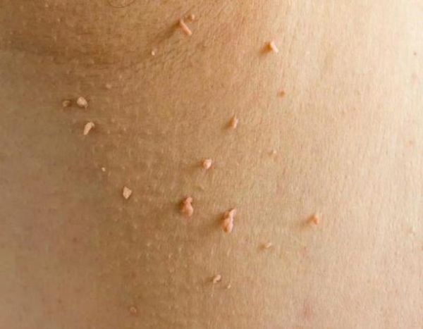 菜花病女性一般长在哪_初期症状有哪些-第3张图片-山城妙识