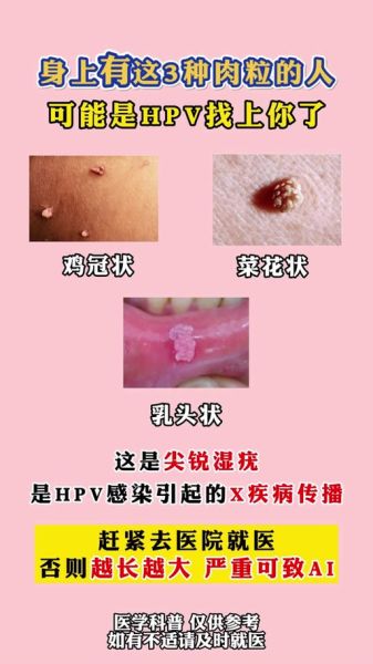 菜花病女性一般长在哪_初期症状有哪些-第2张图片-山城妙识