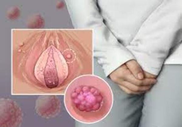 菜花病女性一般长在哪_初期症状有哪些-第1张图片-山城妙识