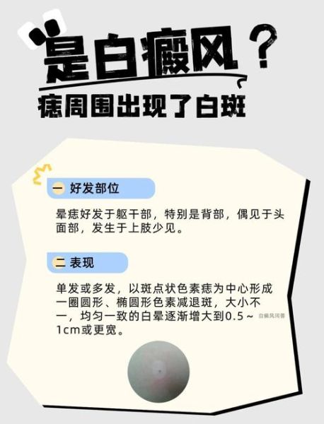 色素减退斑是怎么引起的_能自愈吗-第3张图片-山城妙识 色素减退斑是怎么引起的_能自愈吗-第3张图片-山城妙识