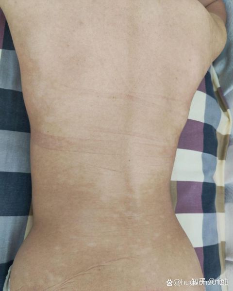 色素减退斑是怎么引起的_能自愈吗-第2张图片-山城妙识 色素减退斑是怎么引起的_能自愈吗-第2张图片-山城妙识